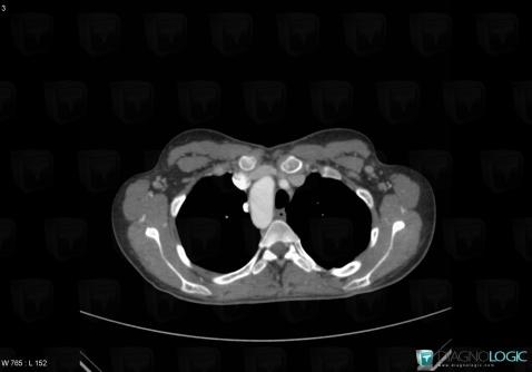 Radiology case : Normal variant (CT) - Diagnologic