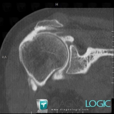 Radiology case : Rotator cuff tears (CT) - Diagnologic