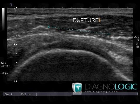 Radiology case : Rotator cuff tears (US ,MRI) - Diagnologic