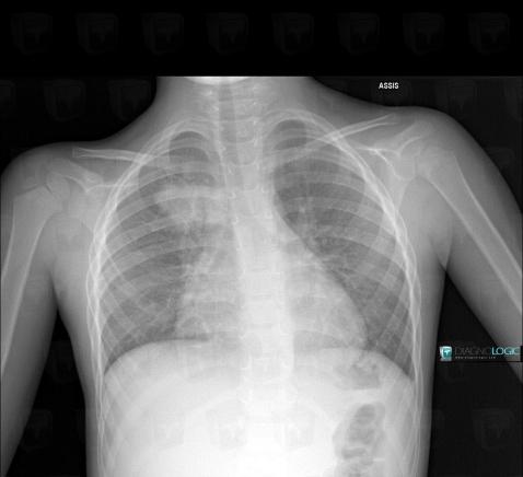 Radiology case : Round pneumonia (X rays) - Diagnologic