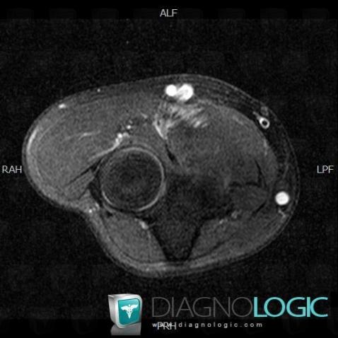 Cas radiologie : Rupture du tendon du biceps brachial (IRM ,Echographie ...