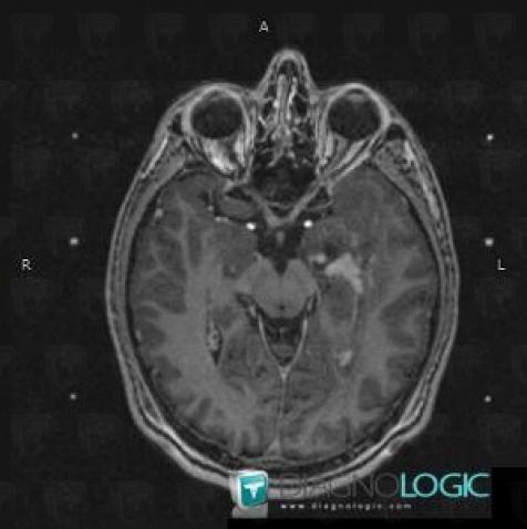 Radiology case : Sarcoidosis (MRI) - Diagnologic