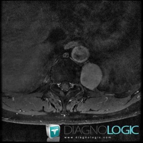 Radiology case : Schwannoma (MRI ,X rays ,CT) - Diagnologic