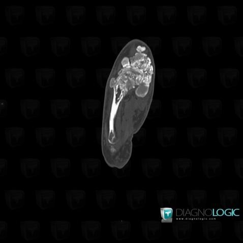 Radiology case : Scleroderma (CT ,US ,X rays) - Diagnologic