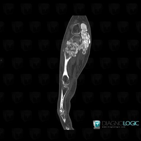 Radiology case : Scleroderma (CT ,US ,X rays) - Diagnologic