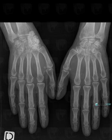 Radiology case : Scleroderma (CT ,US ,X rays) - Diagnologic