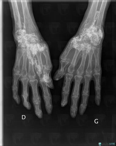 Cas radiologie : Sclérodermie (Radio) - Diagnologic