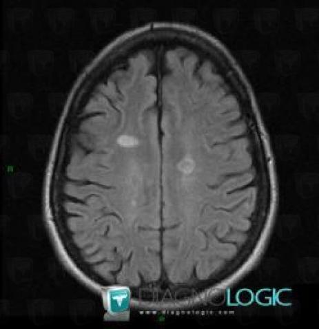 Cas radiologie : Sclérose en plaques (IRM) - Diagnologic