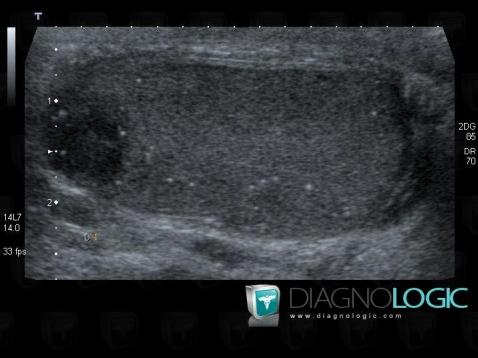 Radiology case : Seminoma (US ,MRI) - Diagnologic
