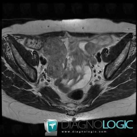 Radiology case : Serous cysteadenocarcinoma (MRI) - Diagnologic