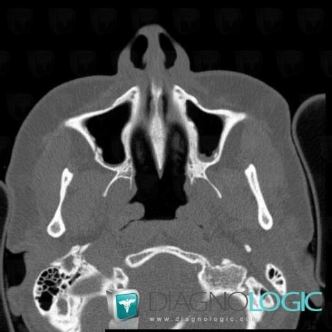 Cas radiologie : Sinusite chronique (Scanner) - Diagnologic