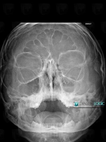 Cas radiologie : Sinusite (Radio) - Diagnologic