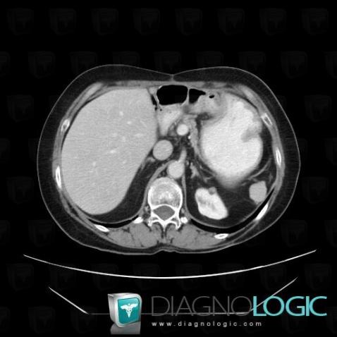 Cas radiologie : Métastase (Scanner) - Diagnologic