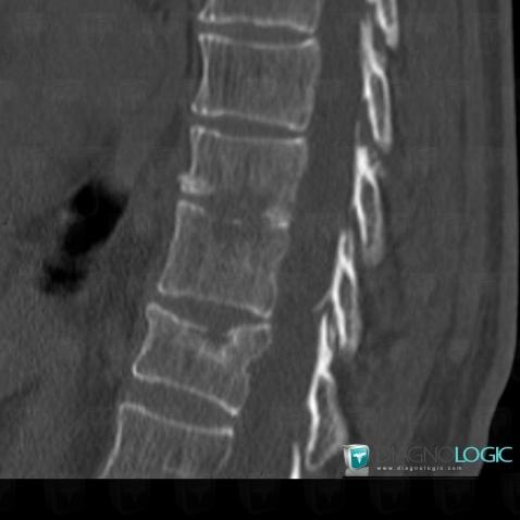 Cas radiologie : Spondylodiscite (Scanner ,Radio) - Diagnologic