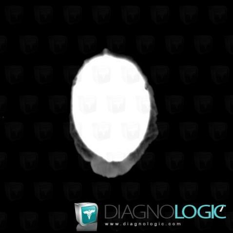 Radiology case : Squamous cell carcinoma (CT) - Diagnologic