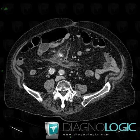 Cas radiologie : Appendicite (Scanner ,Radio) - Diagnologic