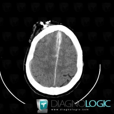 Radiology case : Foreign body (CT) - Diagnologic