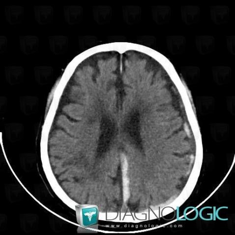 Radiology case : Subdural hematoma (CT) - Diagnologic