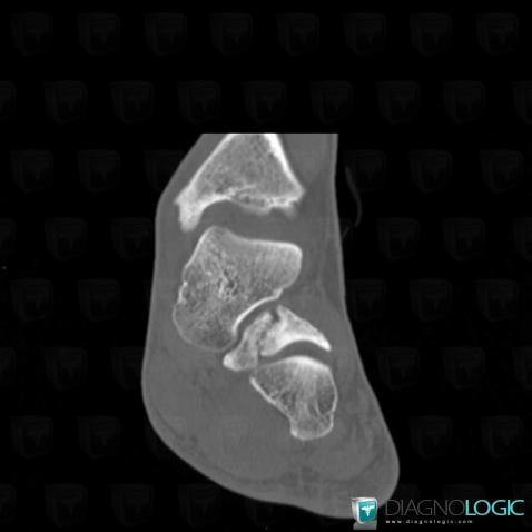 Radiology case : Syndesmosis (X rays ,CT) - Diagnologic