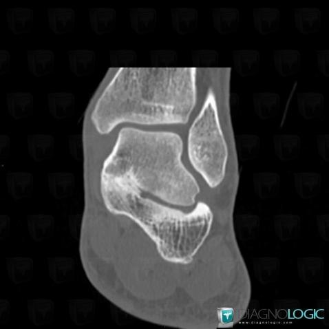 Radiology case : Syndesmosis (X rays ,CT) - Diagnologic