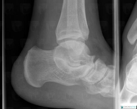 Radiology case : Syndesmosis (X rays ,CT) - Diagnologic