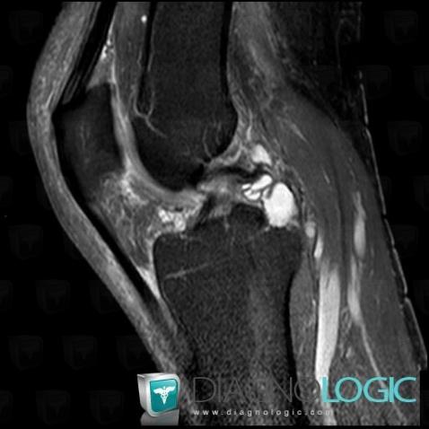 Radiology case : Synovial cyst (MRI) - Diagnologic