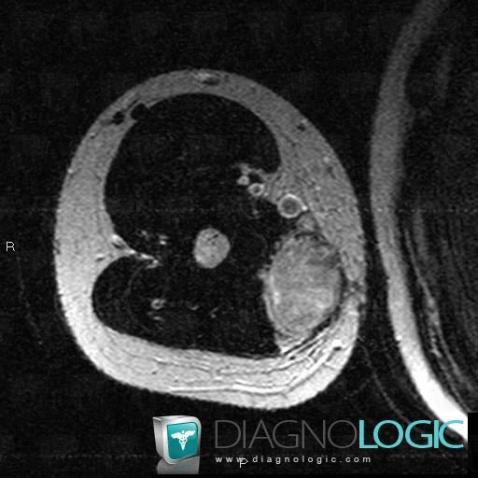 Radiology case : Synovial sarcoma (MRI) - Diagnologic