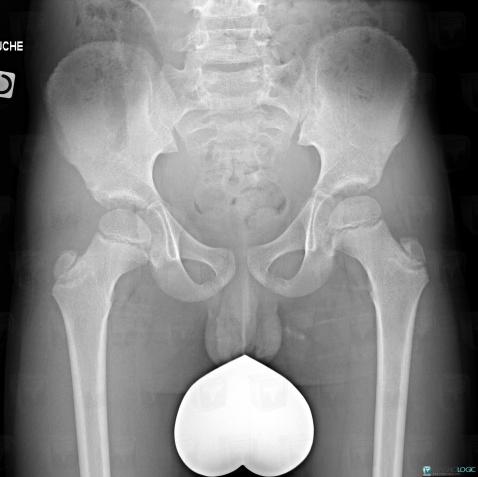 Cas radiologie : Synovite aiguë transitoire (Radio) - Diagnologic