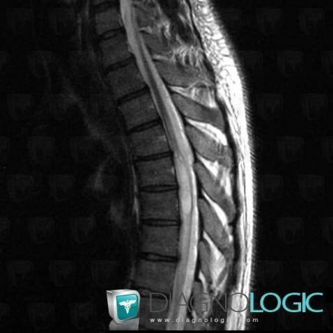 Cas radiologie : Syringomyélie - Diagnologic