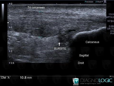 Cas radiologie : Maladie de Haglund (Echographie) - Diagnologic