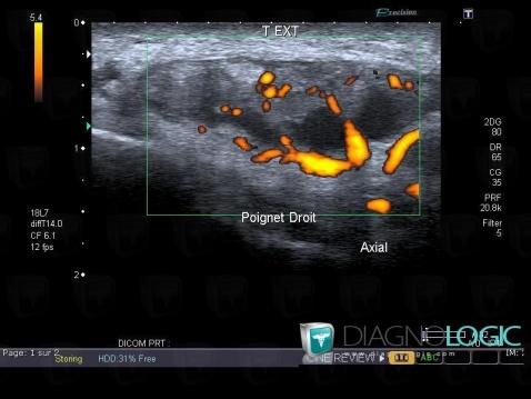 Cas radiologie : Tendinopathie - Ténosynovite Poignet - Main ...