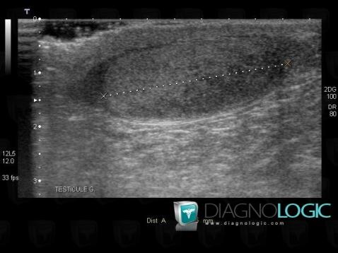 Radiology case : Testicular infarction (US) - Diagnologic