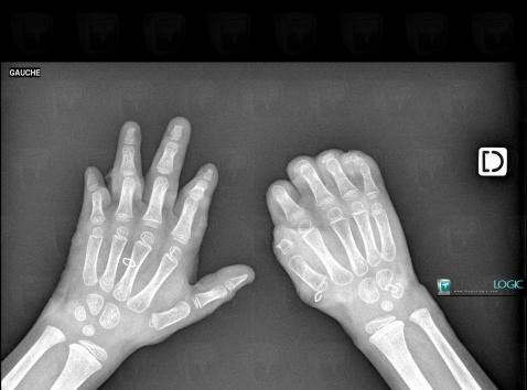 Radiology case : Thermal injury (X rays) - Diagnologic