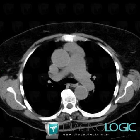 Cas radiologie : Thymome (Scanner) - Diagnologic