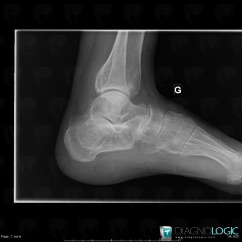 Radiology case : Transient regional osteoporosis (X rays) - Diagnologic