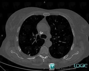 Eggshell Calcification