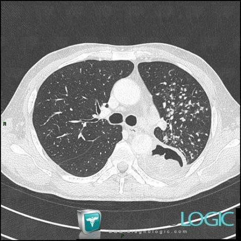 Cas radiologie : Tuberculose (Scanner) - Diagnologic