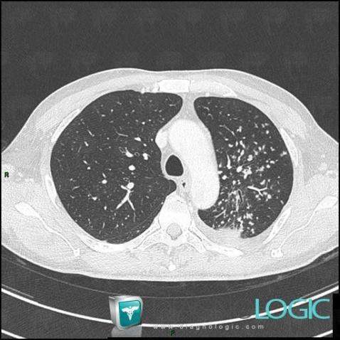 Cas radiologie : Tuberculose (Scanner) - Diagnologic