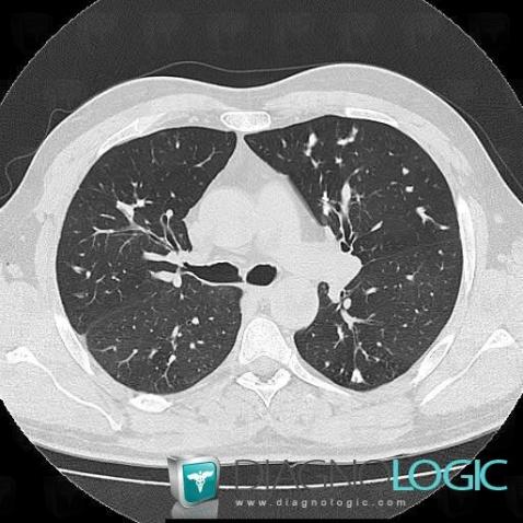 Cas radiologie : Tuberculose (Scanner) - Diagnologic