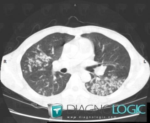 Cas radiologie : Tuberculose (Scanner) - Diagnologic