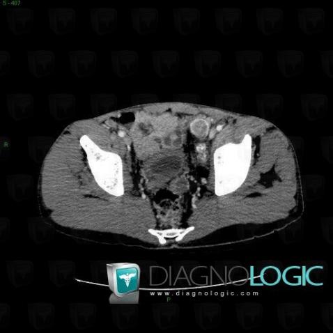 Cas radiologie : Tuberculose (Scanner ,Echographie) - Diagnologic