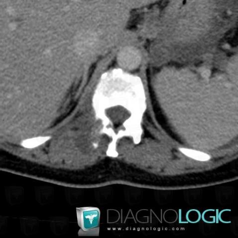 Radiology case : Tuberculosis (CT ,MRI ,US) - Diagnologic
