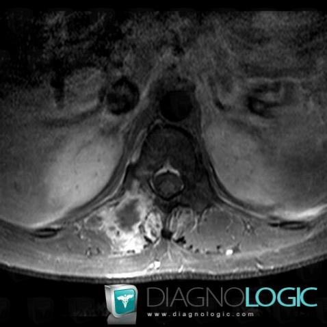 Radiology case : Tuberculosis (CT ,MRI ,US) - Diagnologic