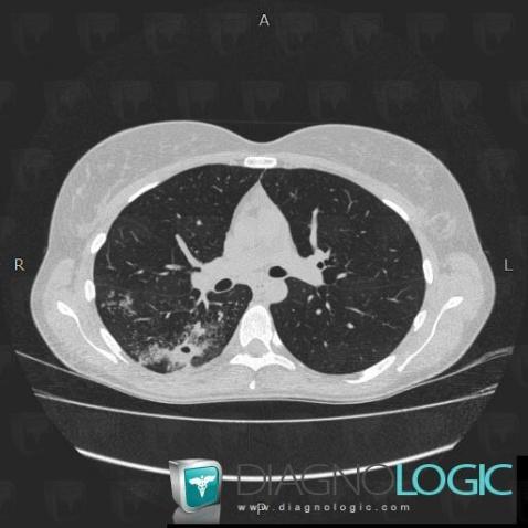 Radiology case : Tuberculosis (CT) - Diagnologic