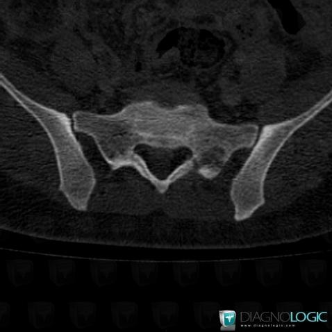 Radiology case : Tuberculosis (CT ,MRI ,US) - Diagnologic
