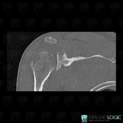 Radiology case : Tuberculosis (CT) - Diagnologic