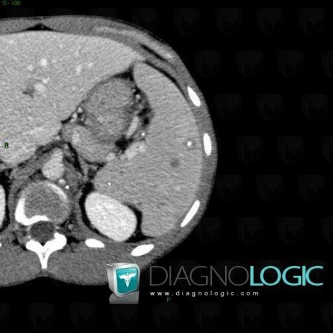 Radiology case : Tuberculosis (US ,CT) - Diagnologic