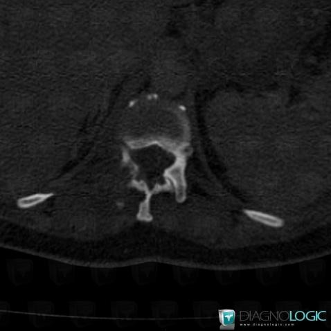 Radiology case : Tuberculosis (CT ,MRI ,US) - Diagnologic