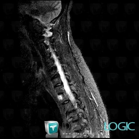 Radiology case : Tuberculosis (CT ,MRI ,US) - Diagnologic