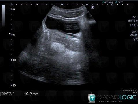 Radiology case : Ureterocele (US) - Diagnologic